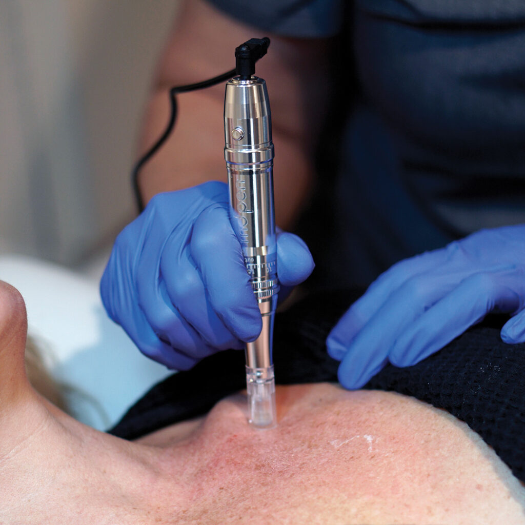 Microneedling » Alban Acupuncture